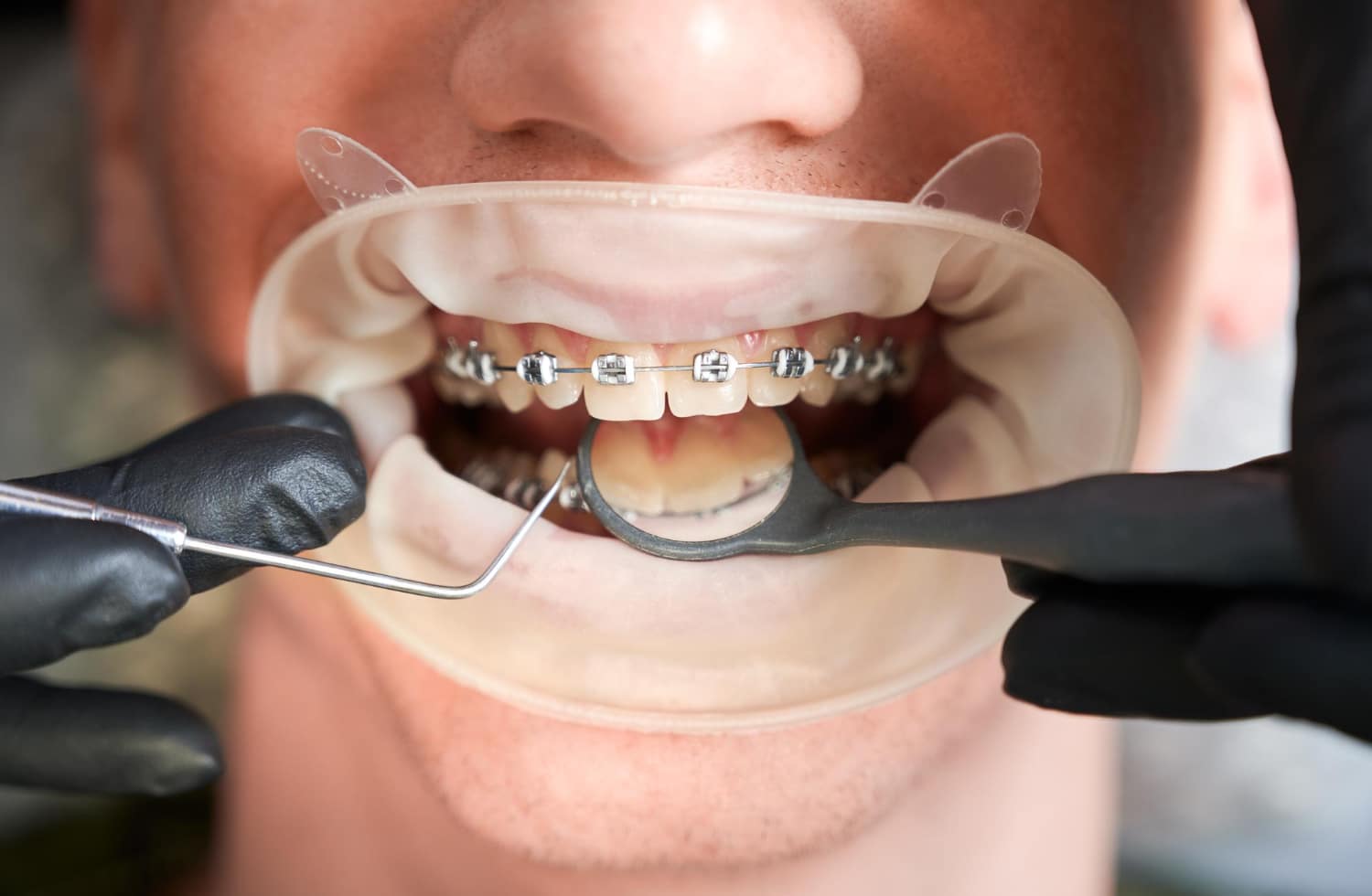 What Is The Best Age To Get An Orthodontic Treatment?