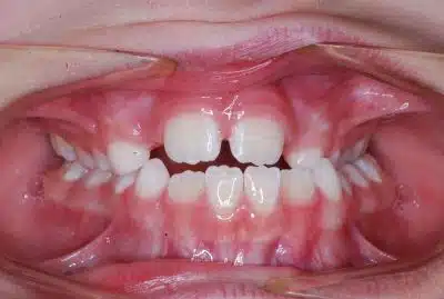 Common Orthodontic Problems | Riverside Orthodontics